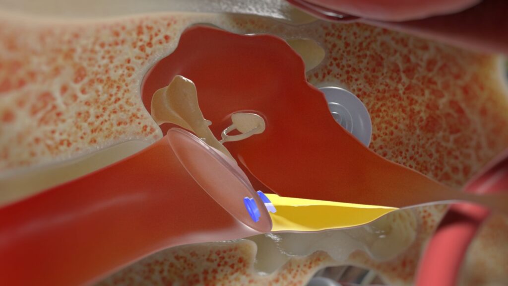 Ear Tube Surgery - Op. Dr. Rıdvan Duran